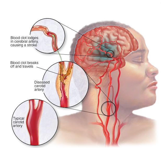 Ischemic Stroke Detection using Machine Learning - My Portfolio